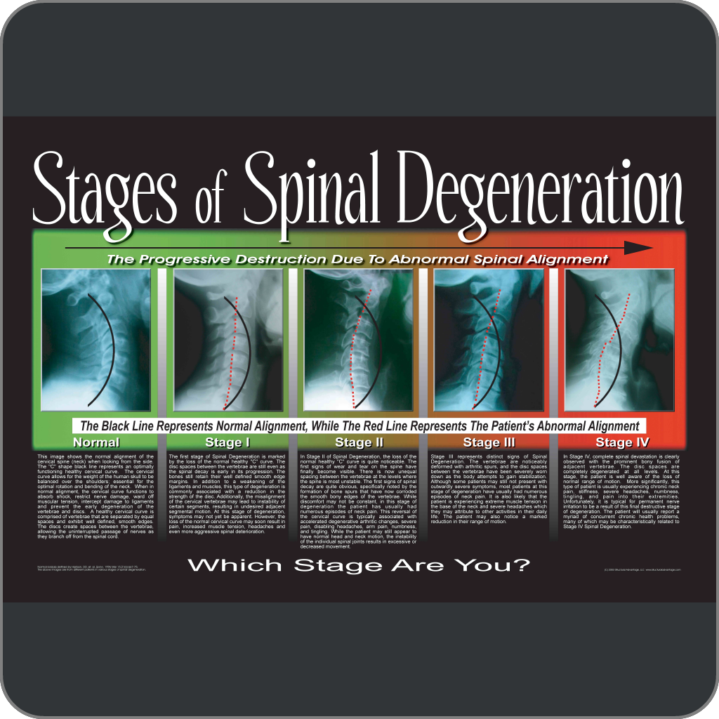 Stages of Spinal Degeneration Poster - MIND VIRUS