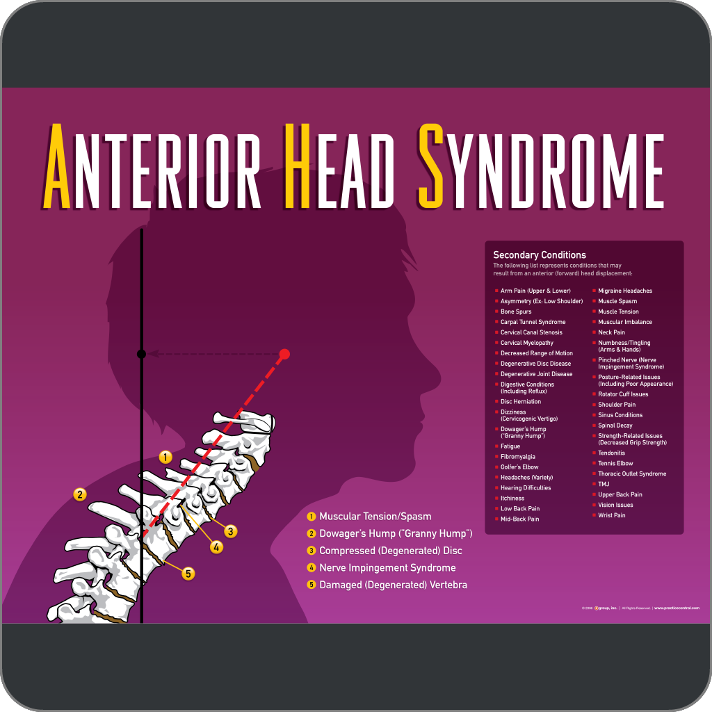 Anterior Head Syndrome Poster - MIND VIRUS